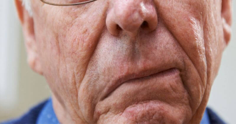 Udar mózgu. Zobacz przyczyny, objawy, diagnozę i leczenie