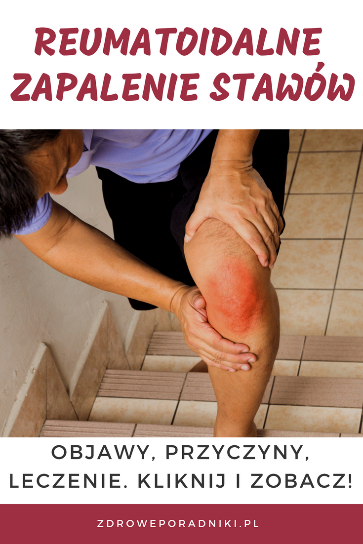 Reumatoidalne zapalenie stawów (RZS) objawy, przyczyny, leczenie
