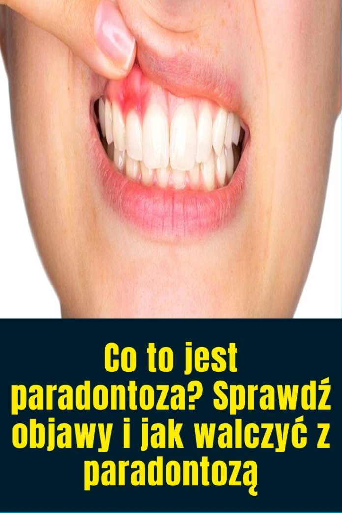 Co to jest paradontoza? Sprawdź objawy i jak walczyć z paradontozą