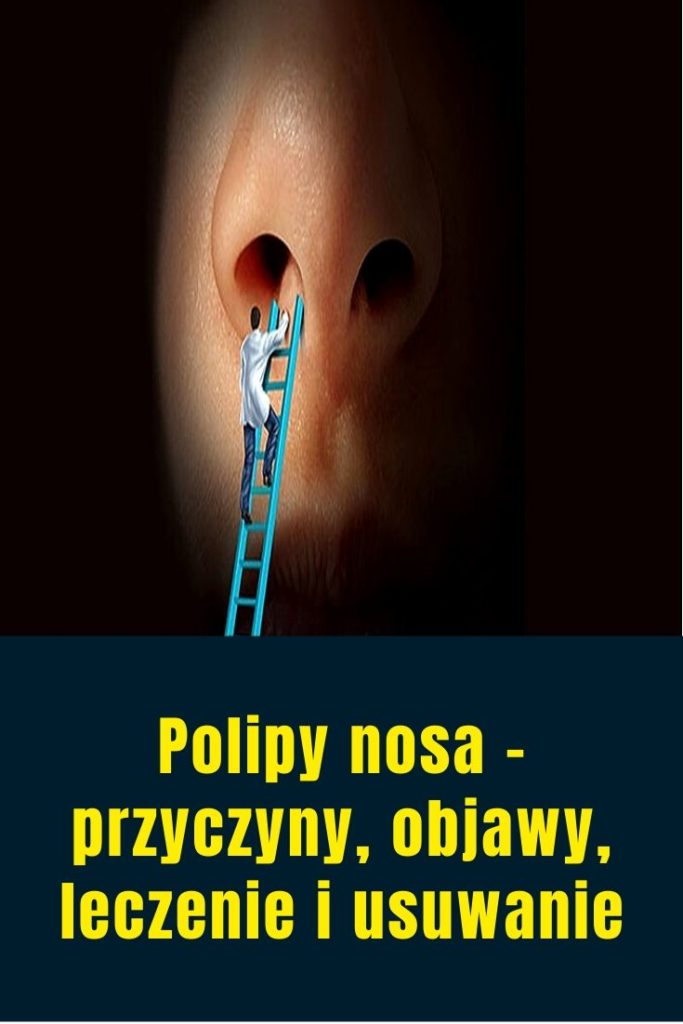 Polipy nosa - przyczyny, objawy, leczenie i usuwanie